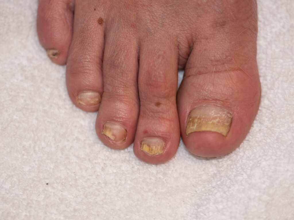Fungal Toenails - Podiatry Quest