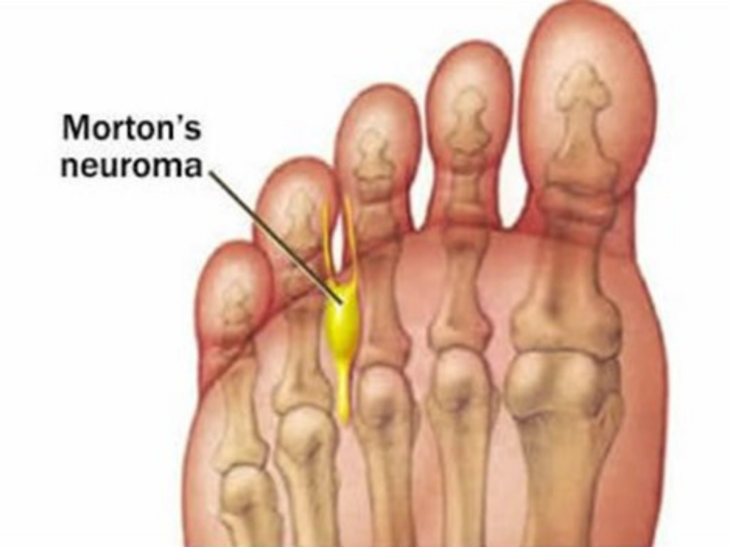 Morton's Neuroma / Metatarsalgia - Podiatry Quest
