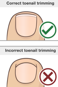 Ingrown Toenail: Tips from a Podiatrist to Prevent Ingrown Toenails