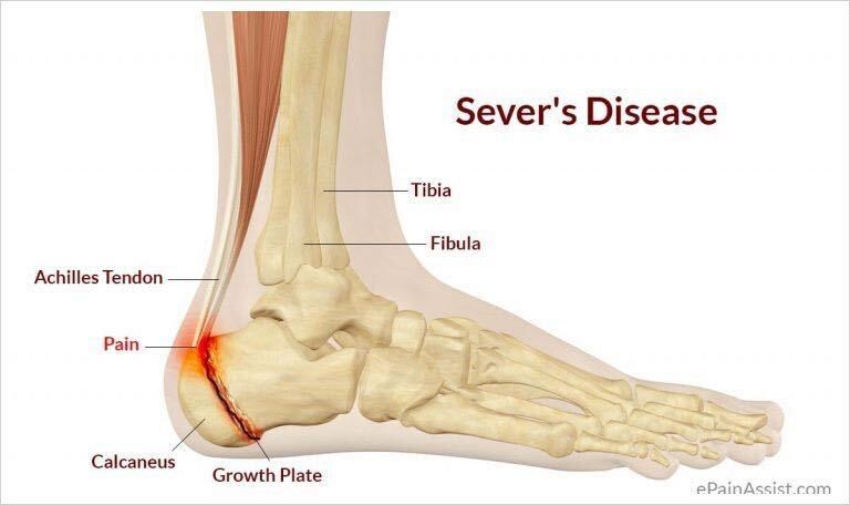 Paediatric Podiatry: 4 Common Issues Among Children