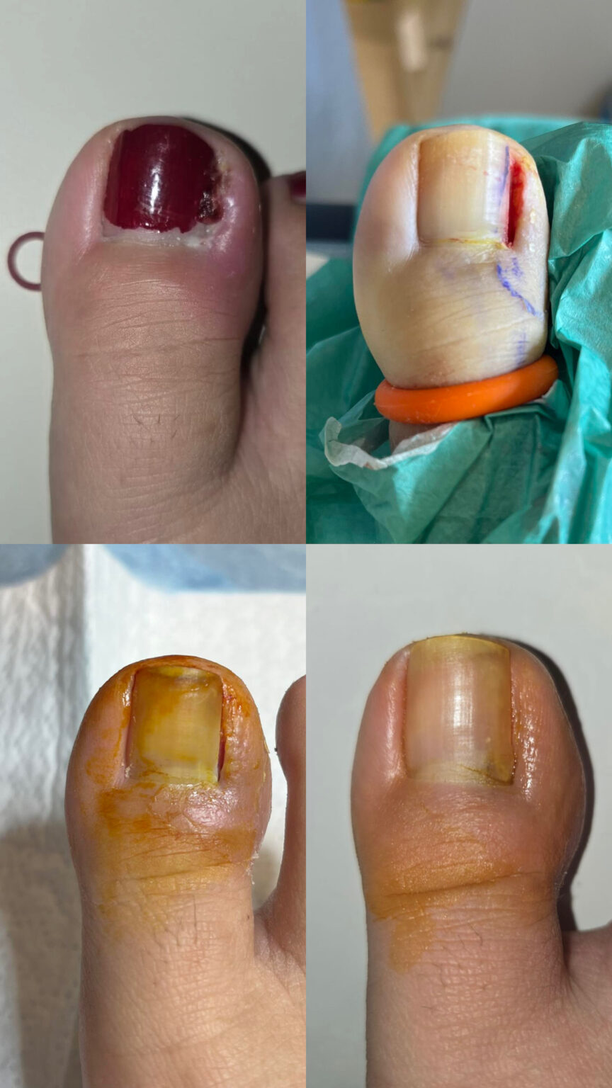 Partial Nail Avulsion Procedure (Ingrown Toenail Surgery) - Podiatry Quest