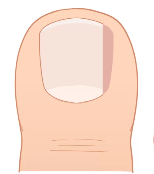 Partial Nail Avulsion Procedure (Ingrown Toenail Surgery) - Podiatry Quest